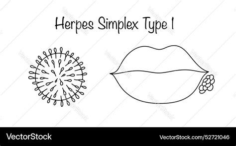 Herpes Simplex Type 1 Royalty Free Vector Image