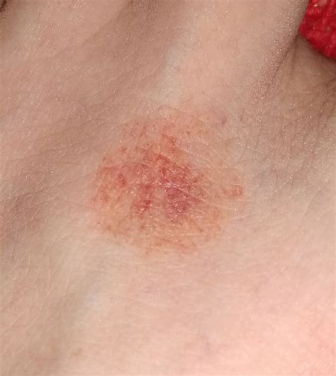 Непонятные красные пятна на стопе Красные пятна стопа Medaboutme