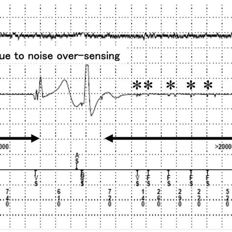 Ventricular Leads Were Located Away From The Diagonal Branch Guide Wire Download Scientific