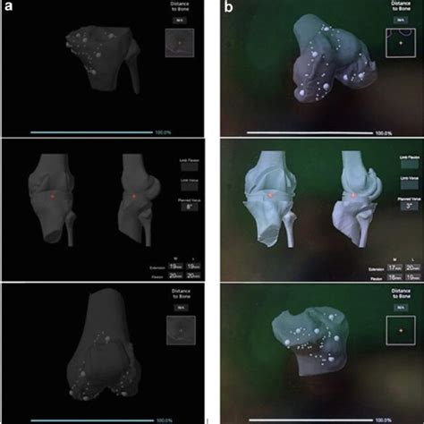 A Case 1 And B Case 2 Intraoperative Registration With The Mako Robot Download Scientific