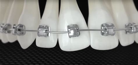 Damon Ultima System Dr Balla Fogszabályozás