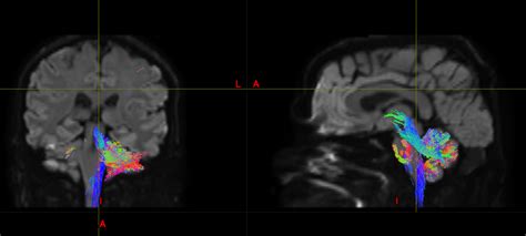 tractography pipeline mrtrix3 community