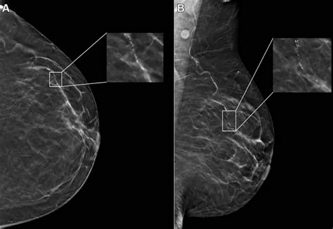Example Mammogram Assigned A F Image Eurekalert Science News Releases
