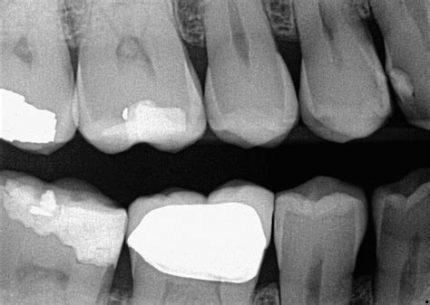 Instant And Accurate Detection Of Early Occlusal Caries Dentistry Today