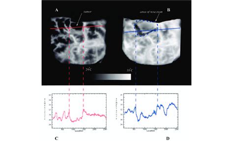 Reorganization Of Cortical Temperature Gradients After Tumor Resection