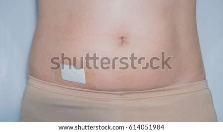 Appendectomy Stock Images Royalty Free Images Vectors Shutterstock