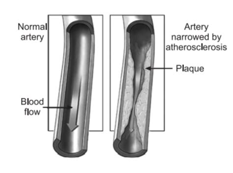Atherosclerosis Causes Pathophysiology Symptoms Pronunciation