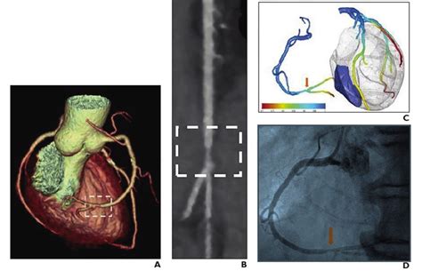 Dl Based Rapid Ffr Ct Algorithm Facilitates Clinical Adoption Applied Radiology