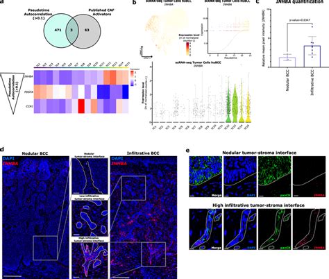 Inhba Is Preferentially Expressed In The Highly Infiltrative Tumor Download Scientific Diagram