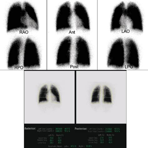 Lung Perfusion Scan Price In Delhi Nuclear Perfusion Cost Near Me India Ganesh Diagnostic