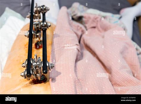 Pov View Of External Fixation Device On Hip And Pelvic In Patient With Pelvic Fracture Stock