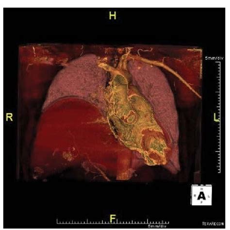 3d Ct Reconstruction Demonstrating Extent Of Hemidiaphragm Elevation Download Scientific Diagram