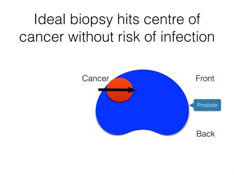 What Are The Problems With Transrectal Biopsies Of The Prostate For