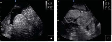 Turtle Sign Ultrasound