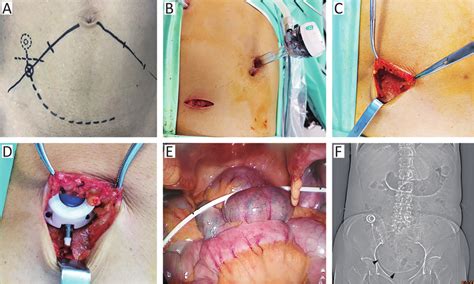 Figure S1 Procedures Of Implanting And Fixing Port Before Optimization Download Scientific