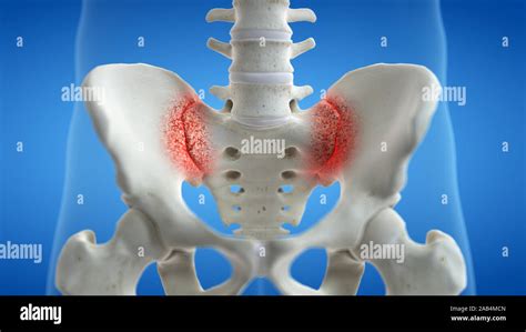 3d Rendered Medically Accurate Illustration Of An Arthritic Iliosacral