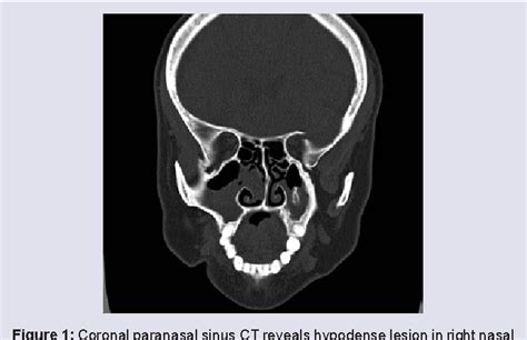 Figure 1 From Concurrence Of Left Maxillary Antrolith And Right Sided