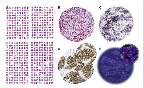 Examples Of Tissue Microarray Tma Applications A Hematoxylin And