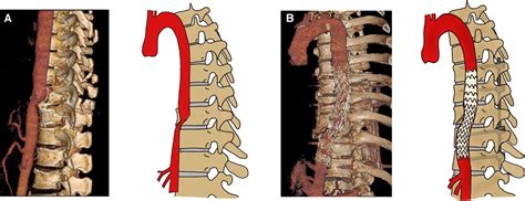 Thoracic Aortic Disruption Distribution Of Open Repairs By Descending