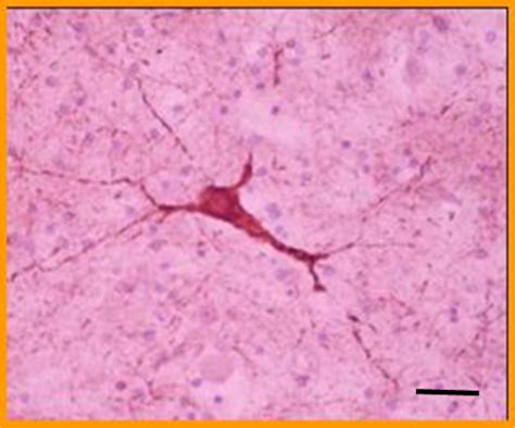 Microphotography Of A P‐gp Positive Dysplastic Neuron Detected In The