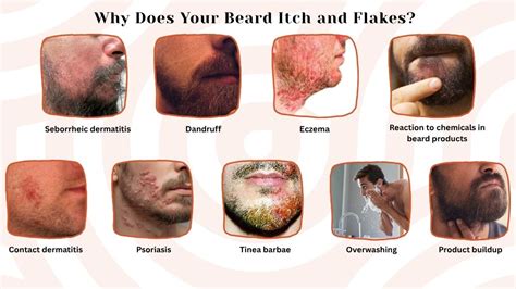 Why Your Beard Itches And Flakes Seborrheic Dermatitis Or Product