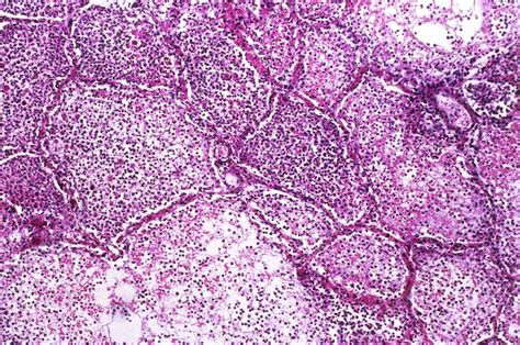 Bronchopneumonia Histology
