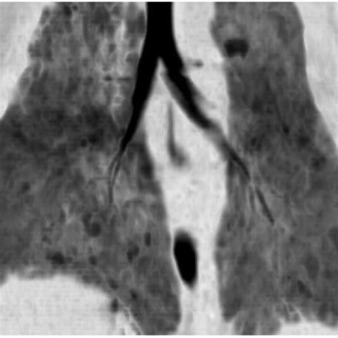 Minimum Intensity Projection Ct Reconstruction Demonstrating Airway Download Scientific Diagram