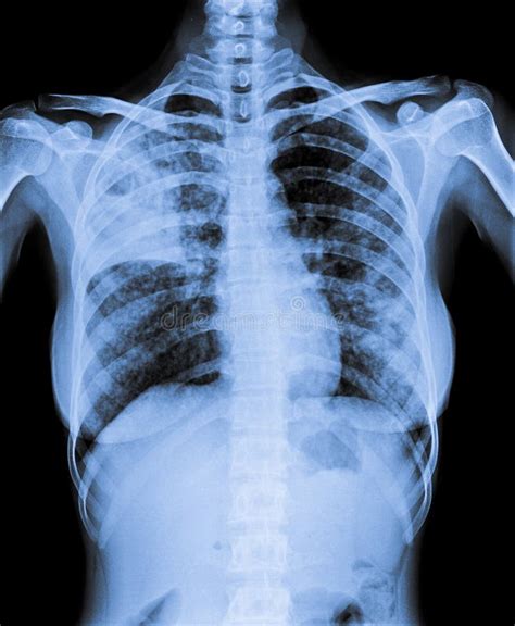 X Ray Of Infected Chest Stock Image Image Of Radiation 74660793