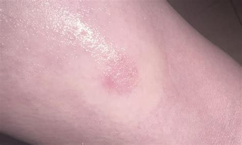 Lyme Disease Or Ringworm Rlymedisease
