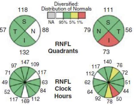 Glaucoma Oct Basics Flashcards Quizlet