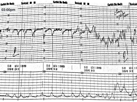 Interesting CTGs Discussion Ppt Download