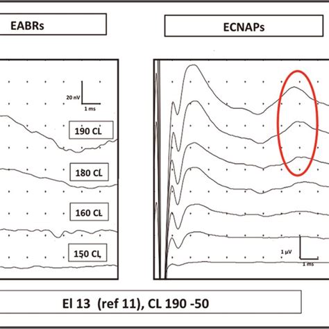 Evoked Auditory Brainstem Response And Electrical Compound Nerve Action