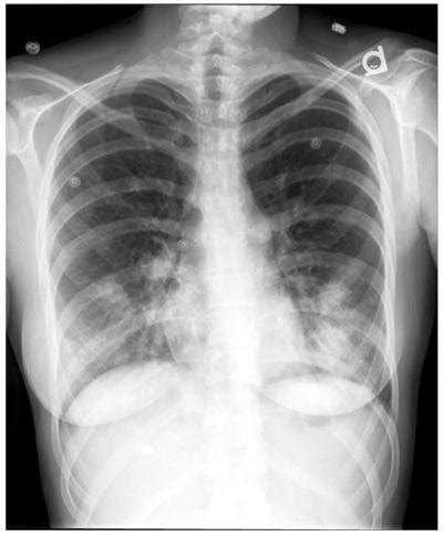 Infiltrate Pneumonia