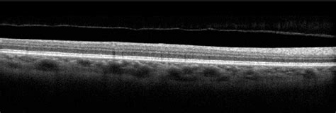 Figure 1 1 From Gan Based Super Resolution And Segmentation Of Retinal