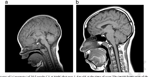 Table 1 From Neonatal Brain Mri Segmentation A Review Semantic Scholar