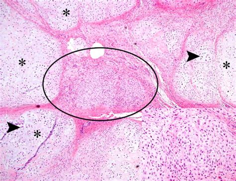 Imaging Of Synovial Chondromatosis With Radiologic Pathologic
