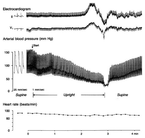 Neurocardiogenic Vasodepressor Syncope Nejm