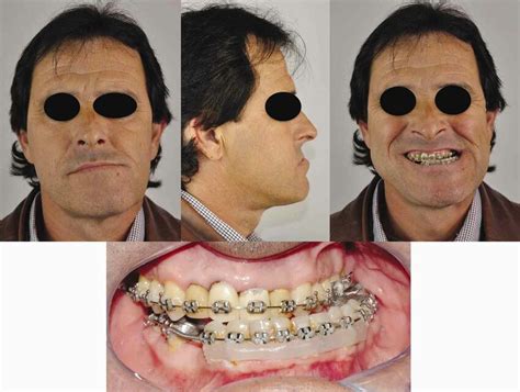 Facial Asymmetry Caused By Mandibular Deviation To The Left Mandibular Download Scientific