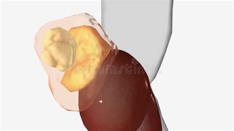 An Adrenal Incidentaloma Is A Solid Mass In One Or Both Adrenal Glands