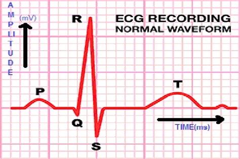 Figure 1 From Noise Elimination And Ecg R Peak Detection Using Wavelet