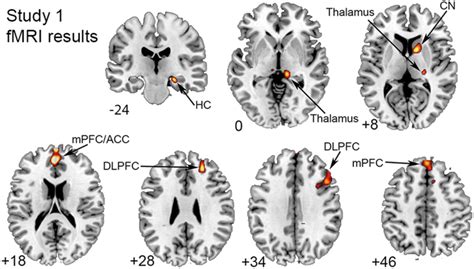 Brain Activation Associated With Implicit Sequence Learning Results