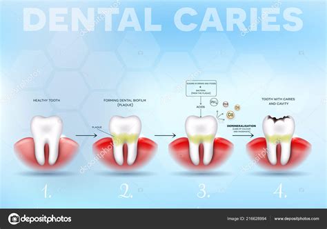 Dental Caries Process