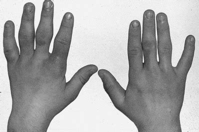 Fusiform Swellings Of The Second Through To The Fifth Digits Of The