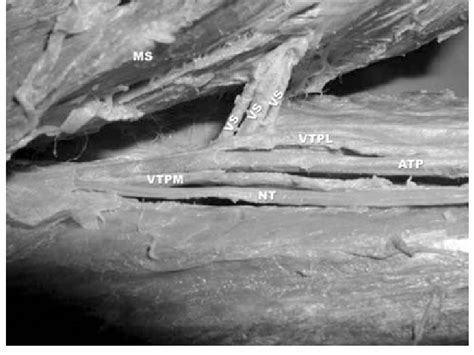 Soleus Vein Termination Into The Posterior Lateral Tibial Vein Ms