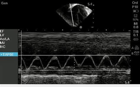 M Mode Tracing Showing Tricuspid Annulus Plane Systolic Excursion Download Scientific Diagram