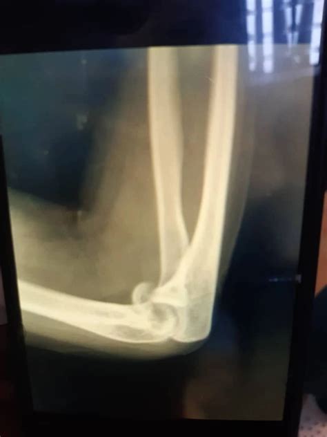 Capitellum Fracture Fixation 22 Y Female Majd Al Nserat