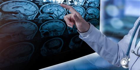 Understanding Multiple Sclerosis A Comprehensive Guide