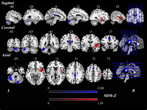 Brain Regions Showing Significant Differences Of Regional Spontaneous