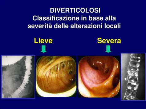 Ppt Diverticoli Del Colon Definizione Powerpoint Presentation Free