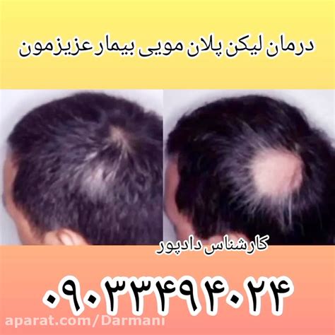 درمان لیکن پلان